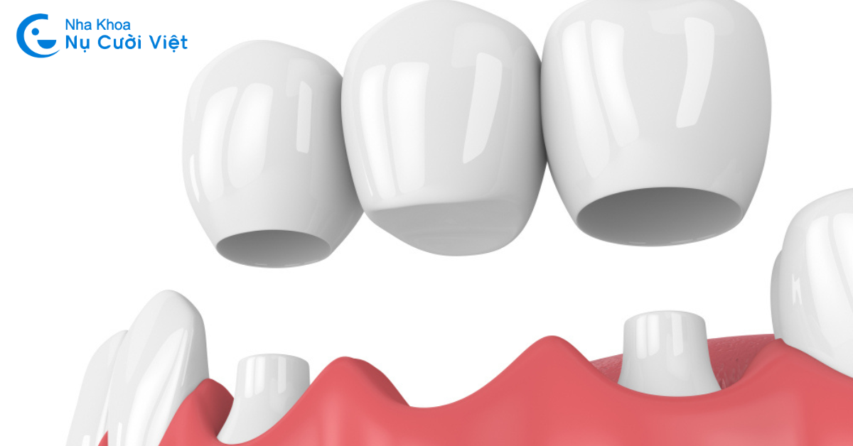 Những phương pháp làm răng giả tốt nhất hiện nay